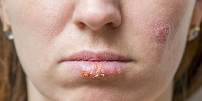 First Herpes Outbreak Female: What to Expect & How to Manage